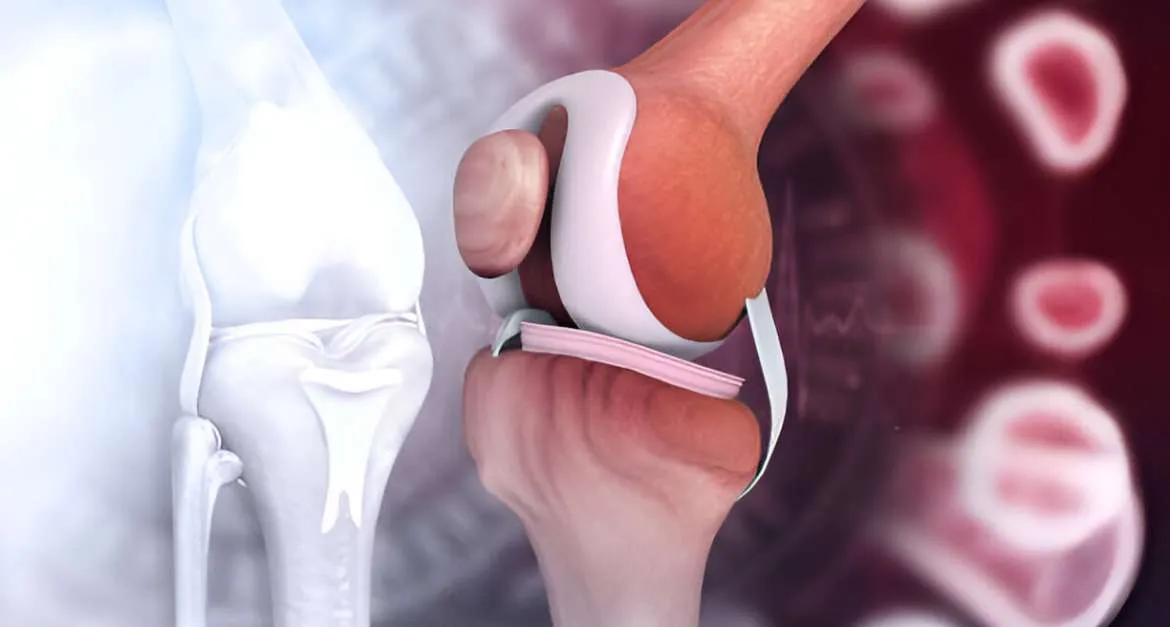 Meniscus Surgery: What You Need to Know | Total Orthocare